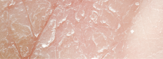 Ruwe huid | Oorzaak en oplossing | Sproet