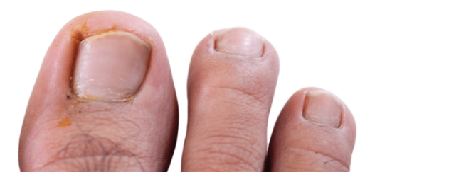 Ingegroeide nagel | Oorzaak en oplossing | Sproet