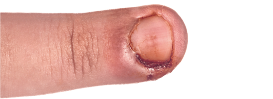 Ingegroeide nagel | Oorzaak en oplossing | Sproet