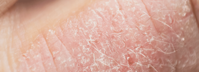 Eczeem handen | Oorzaak en oplossing | Sproet