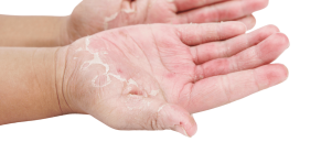 Eczeem handen | Oorzaak en oplossing | Sproet