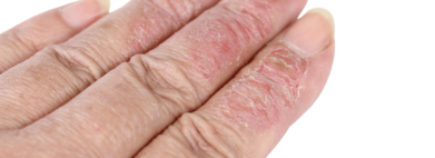 Eczeem handen | Oorzaak en oplossing | Sproet