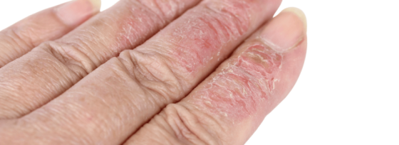 Eczeem handen | Oorzaak en oplossing | Sproet