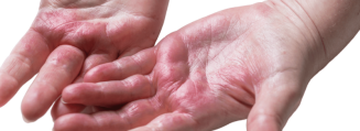 Eczeem handen | Oorzaak en oplossing | Sproet