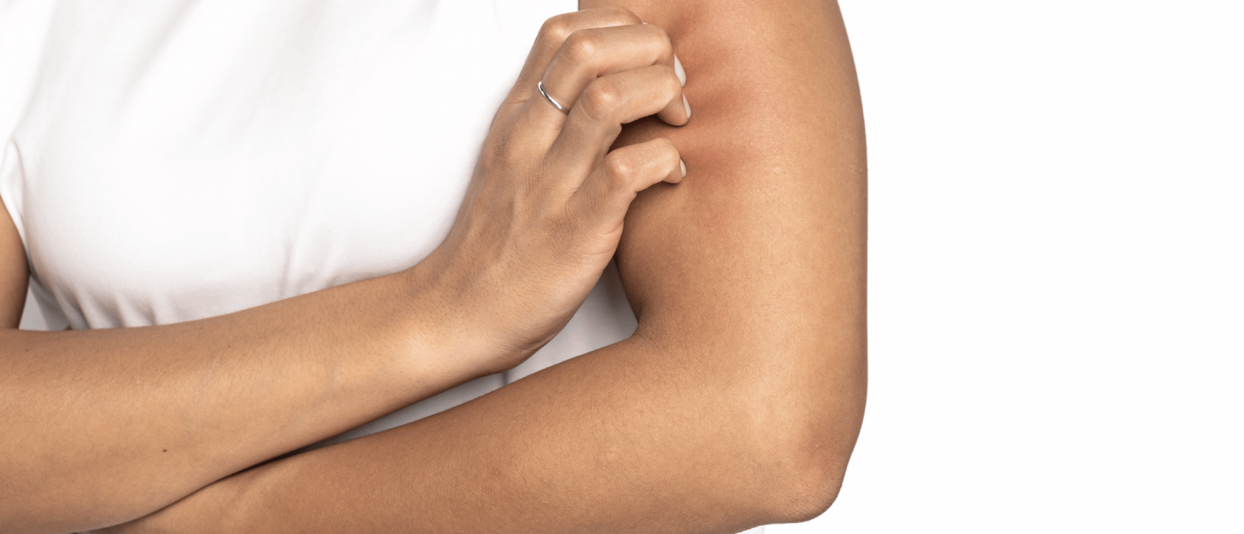 Insectenbeten en jeuk | Oorzaak en tips | Sproet