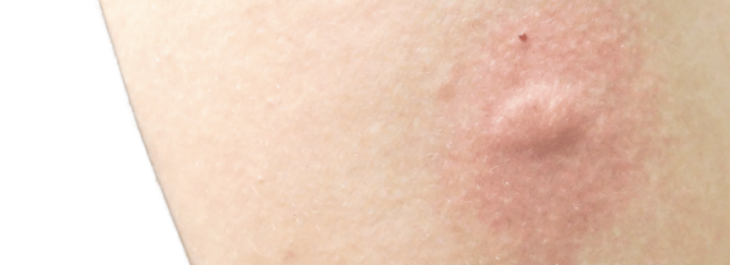 Insectenbeten en jeuk | Oorzaak en tips | Sproet