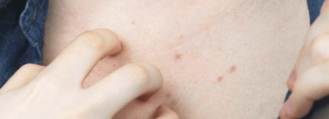 Insectenbeten en jeuk | Oorzaak en tips | Sproet