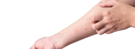 Insectenbeten en jeuk | Oorzaak en tips | Sproet