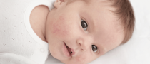 Baby eczeem | Oorzaak en oplossing | Sproet