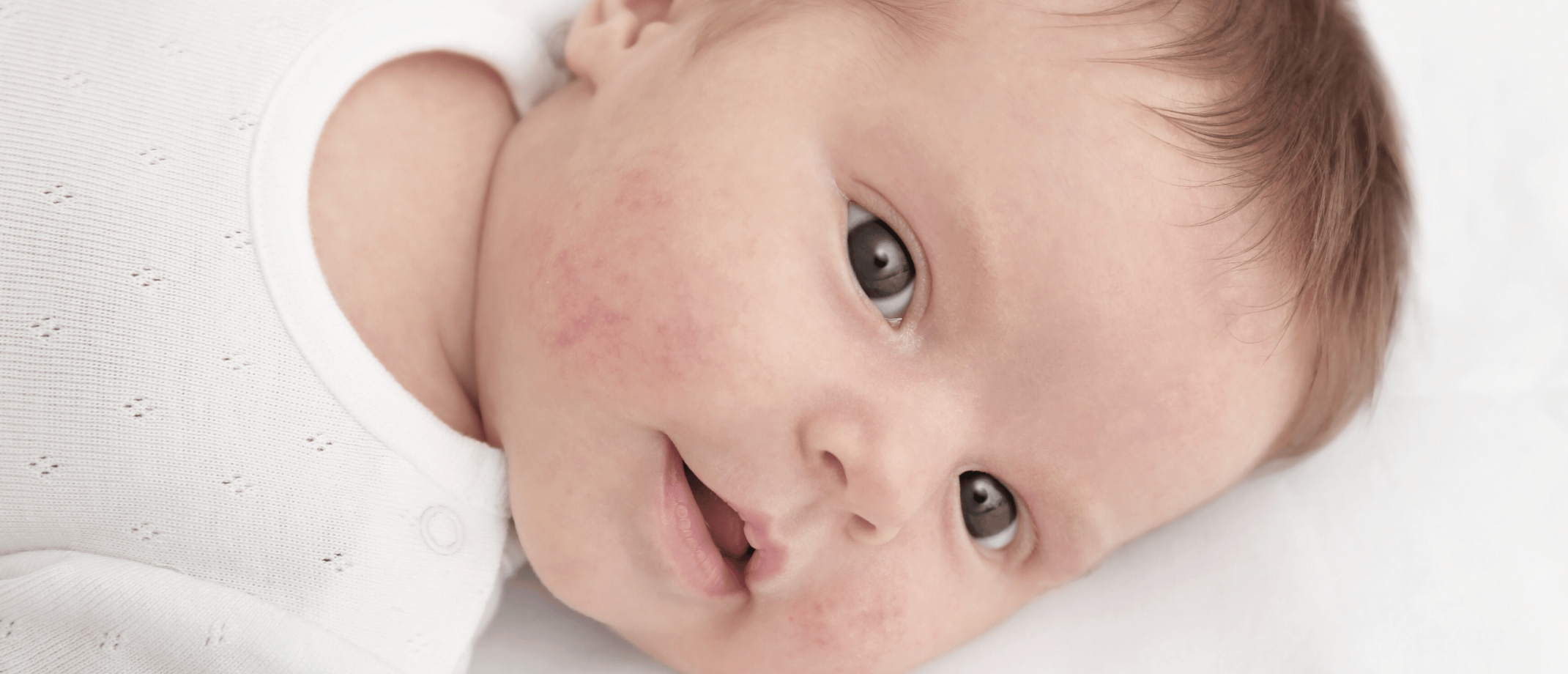 Baby eczeem | Oorzaak en oplossing | Sproet