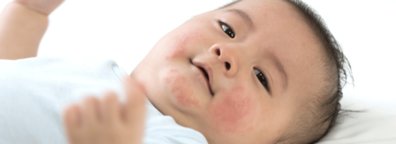 Baby eczeem | Oorzaak en oplossing | Sproet