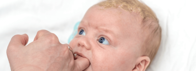 Baby eczeem | Oorzaak en oplossing | Sproet