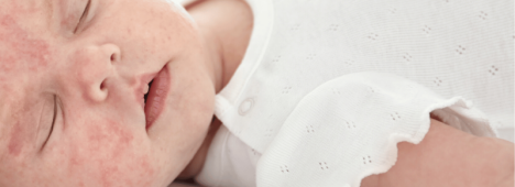 Baby eczeem | Oorzaak en oplossing | Sproet