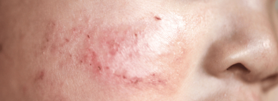 Baby eczeem | Oorzaak en oplossing | Sproet