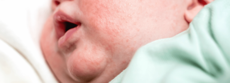 Baby eczeem | Oorzaak en oplossing | Sproet