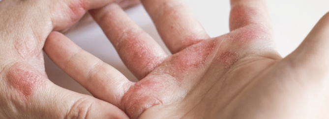 Blaasjeseczeem | Oorzaak en tips | Sproet