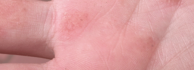 Blaasjeseczeem | Oorzaak en tips | Sproet