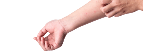 Muggenbulten: zwelling na muggenbeet | Sproet