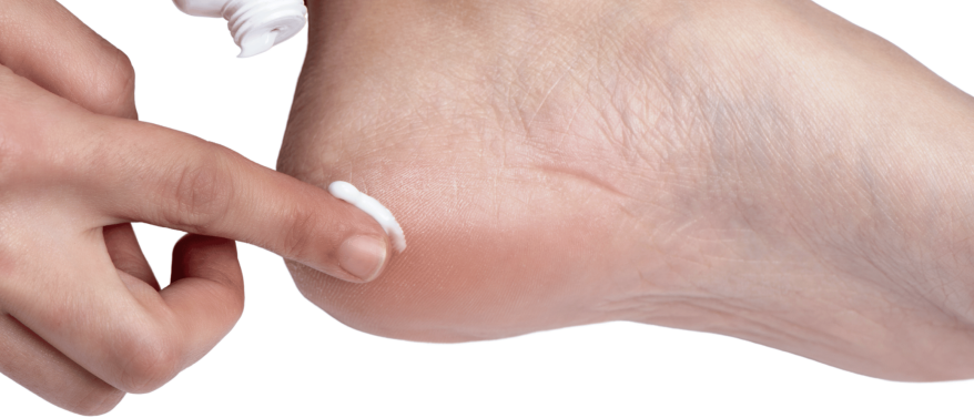 Huidproblemen aan de handen of voeten | Sproet