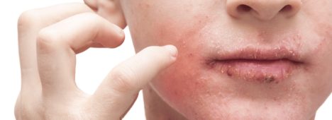 Eczeem lippen | Oorzaak en tips | Sproet