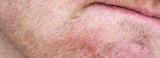 Eczeem lippen | Oorzaak en tips | Sproet