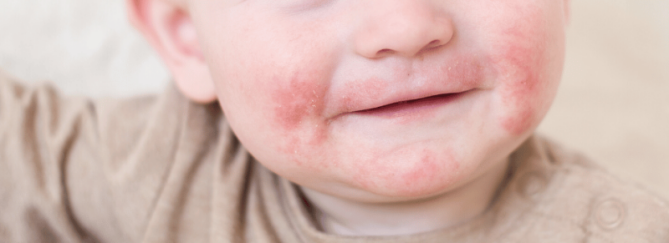 Eczeem lippen | Oorzaak en tips | Sproet