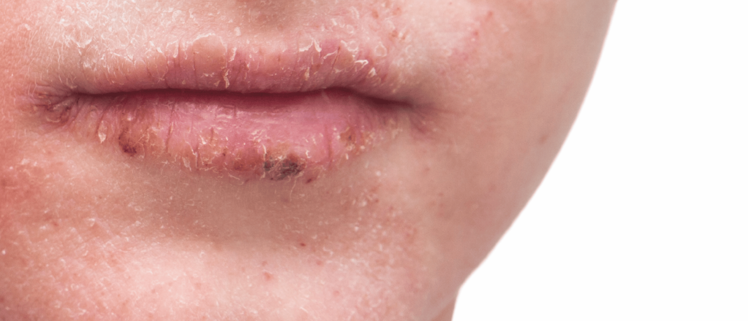 Eczeem lippen | Oorzaak en tips | Sproet