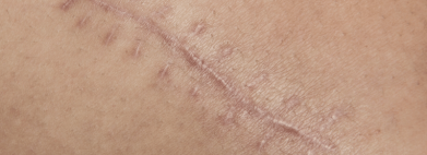 Littekens: hyperpigmentatie, atrofisch, hypertrofisch of keloïd