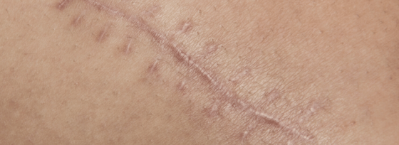 Littekens: hyperpigmentatie, atrofisch, hypertrofisch of keloïd