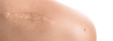 Littekens: hyperpigmentatie, atrofisch, hypertrofisch of keloïd