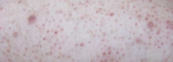 Keratosis pilaris | Mijn ervaring en tips