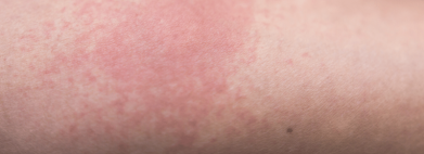 Brandende huid | Mijn tips als huidtherapeut | 2024