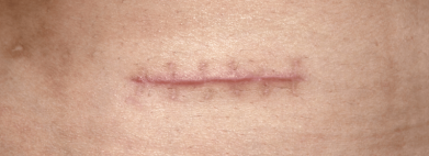 Hypertrofisch litteken | Oorzaak en behandelen | Sproet