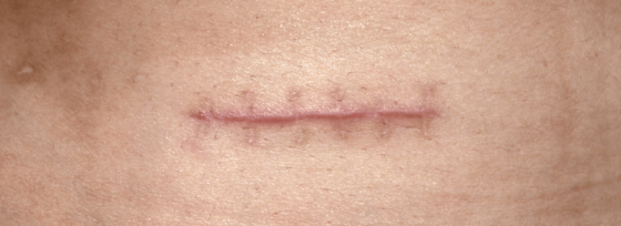 Hypertrofisch litteken | Oorzaak en behandelen | Sproet