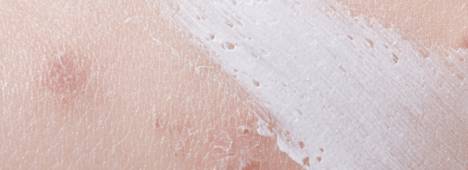 Beste littekencreme 2025 | Mijn top 5 | Sproet