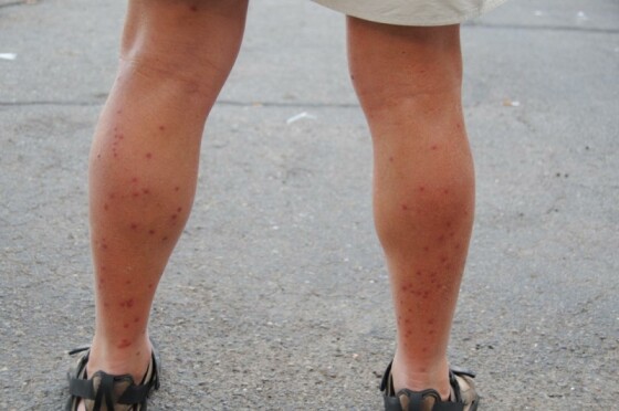 Bedwantsen beet herkennen en behandelen 🛌🏻 Tips en fotos: