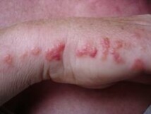 Bedwantsen beet herkennen en behandelen 🛌🏻 Tips en fotos: