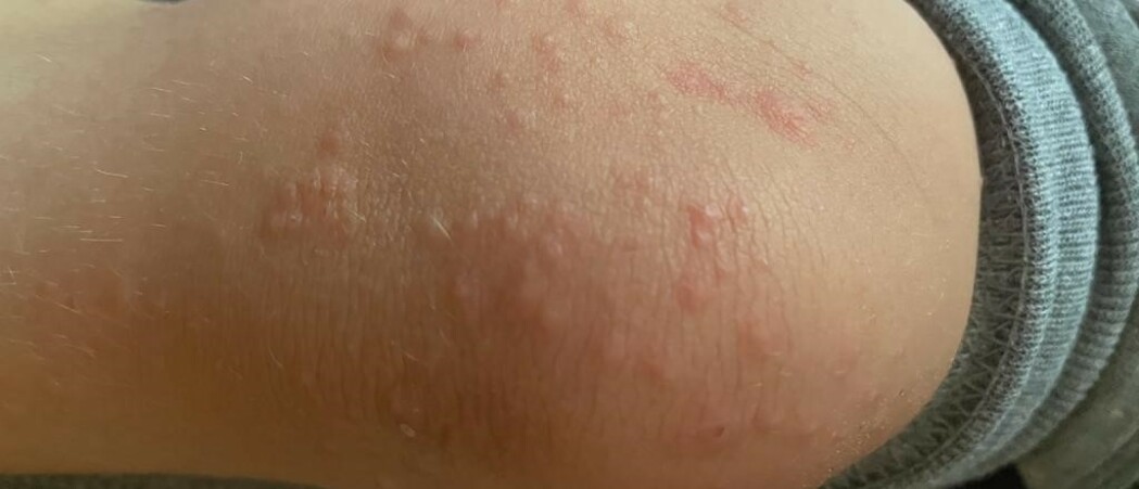 Gianotti Crosti Syndroom | OptimumClinics