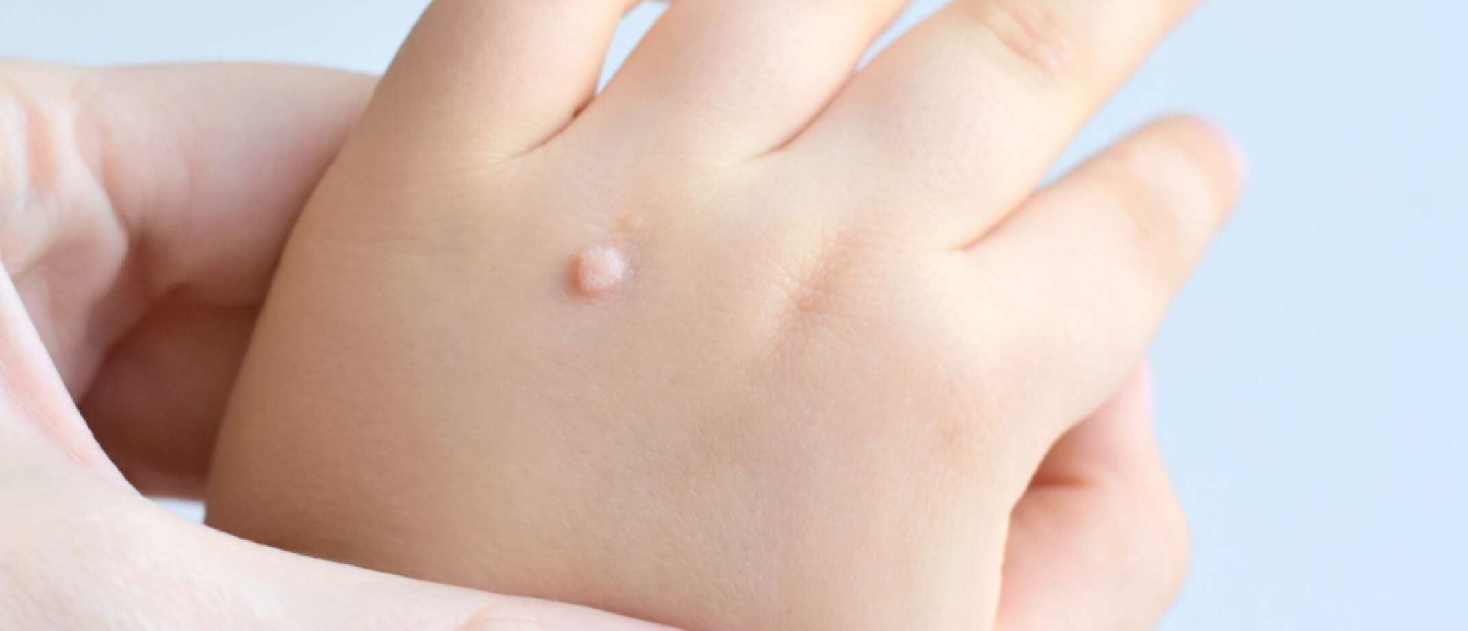 Wat te doen tegen wratten?