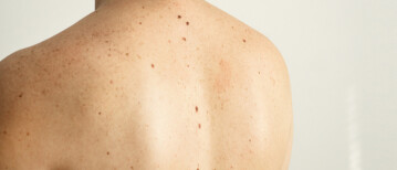 Hoe kun je een moedervlek verwijderen? | OptimumClinics