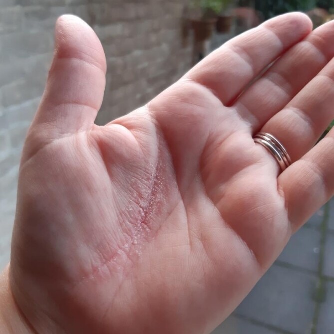 Wat is de oorzaak van eczeem in je handen?