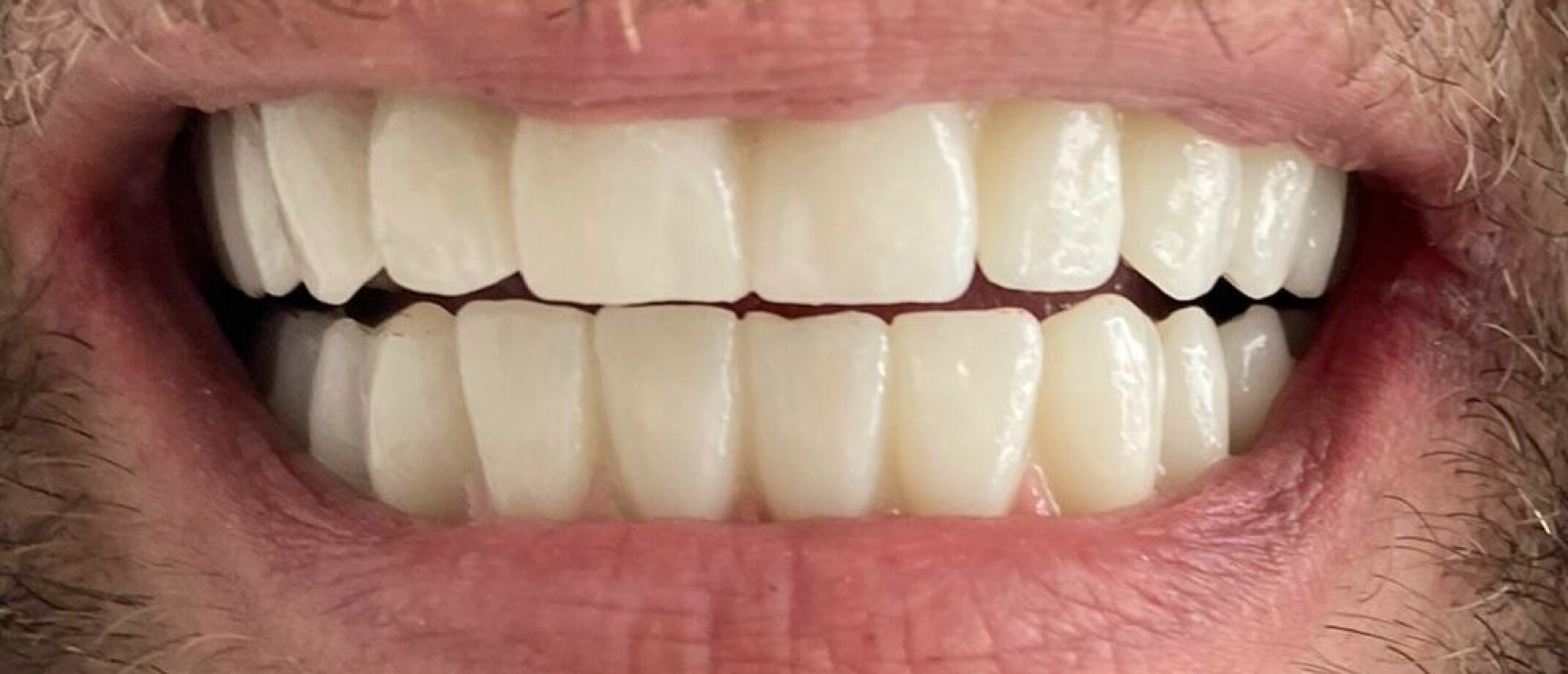 Het Klikgebit: Voordelen en Nadelen vanuit het Oogpunt van een Patiënt