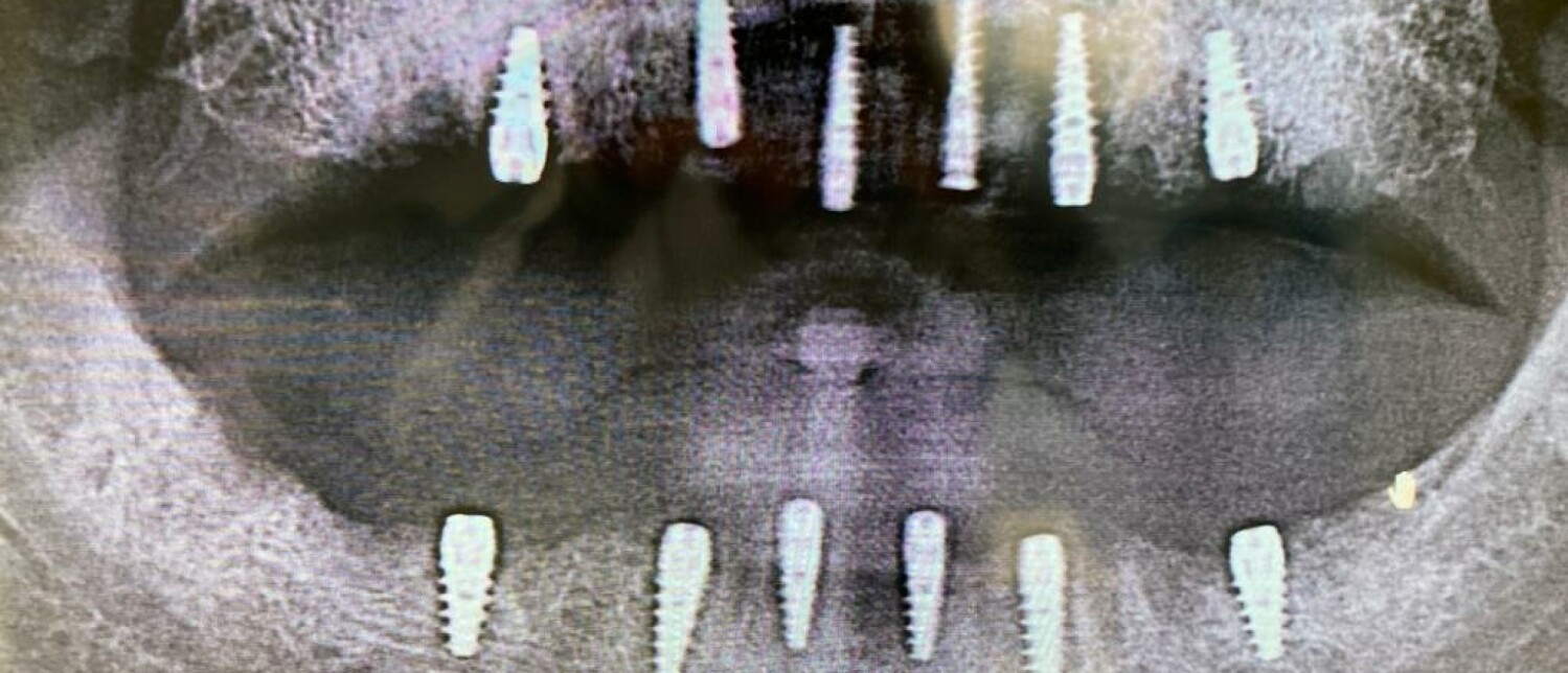 All-on-Four vs. All-on-Six: Een vergelijking van stabiliteit; kosten en ...