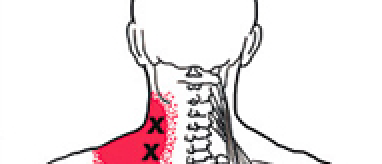 Alles over Trapezius (Monnikskapspier)- behandeling