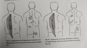 Alles over triggerpoints rug en rugpijn & oplossing