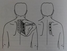 Alles over triggerpoints rug en rugpijn & oplossing