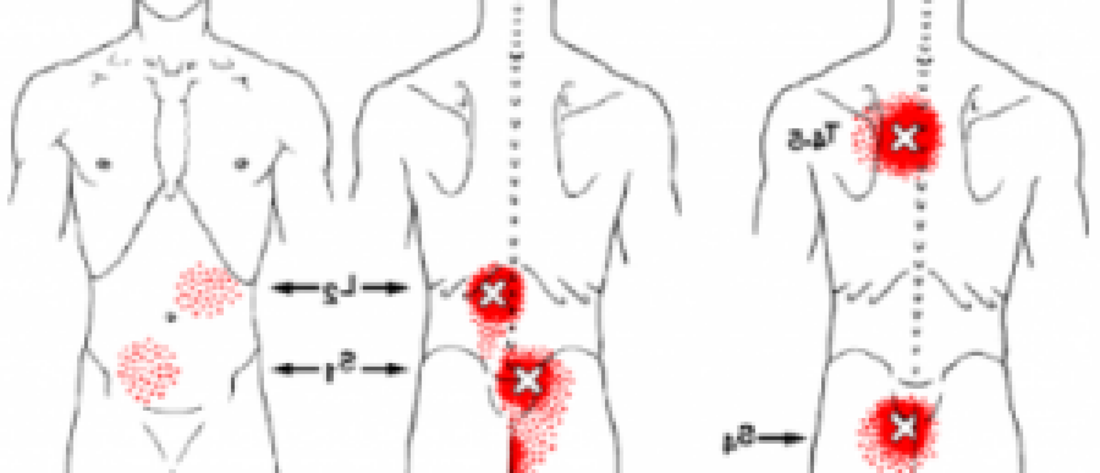 Alles over Trapezius (Monnikskapspier)- behandeling