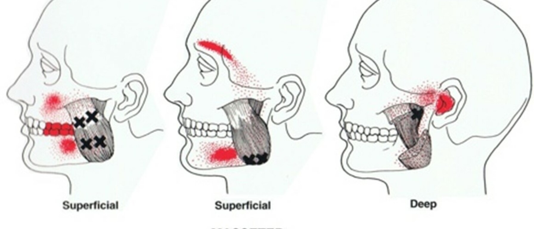 Alles over infraspinatus spier- behandeling klachten