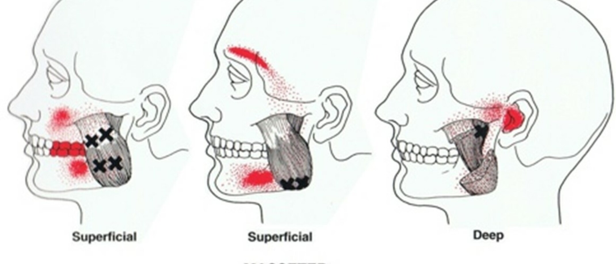 Alles over infraspinatus spier- behandeling klachten