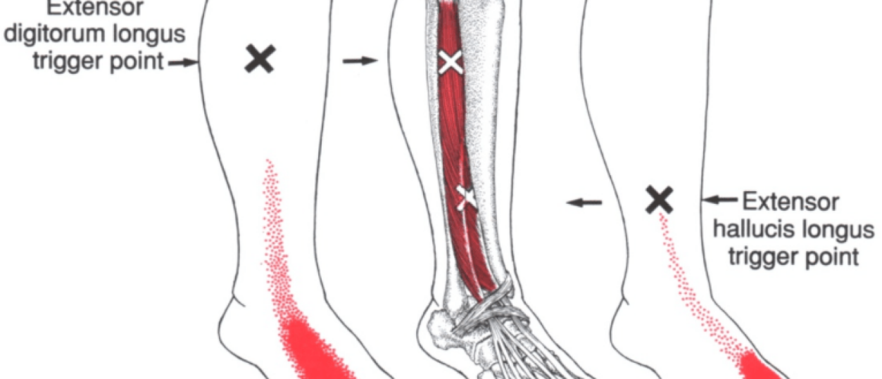 Alles over SI-gewrichtspijn- oorzaken en behandeling